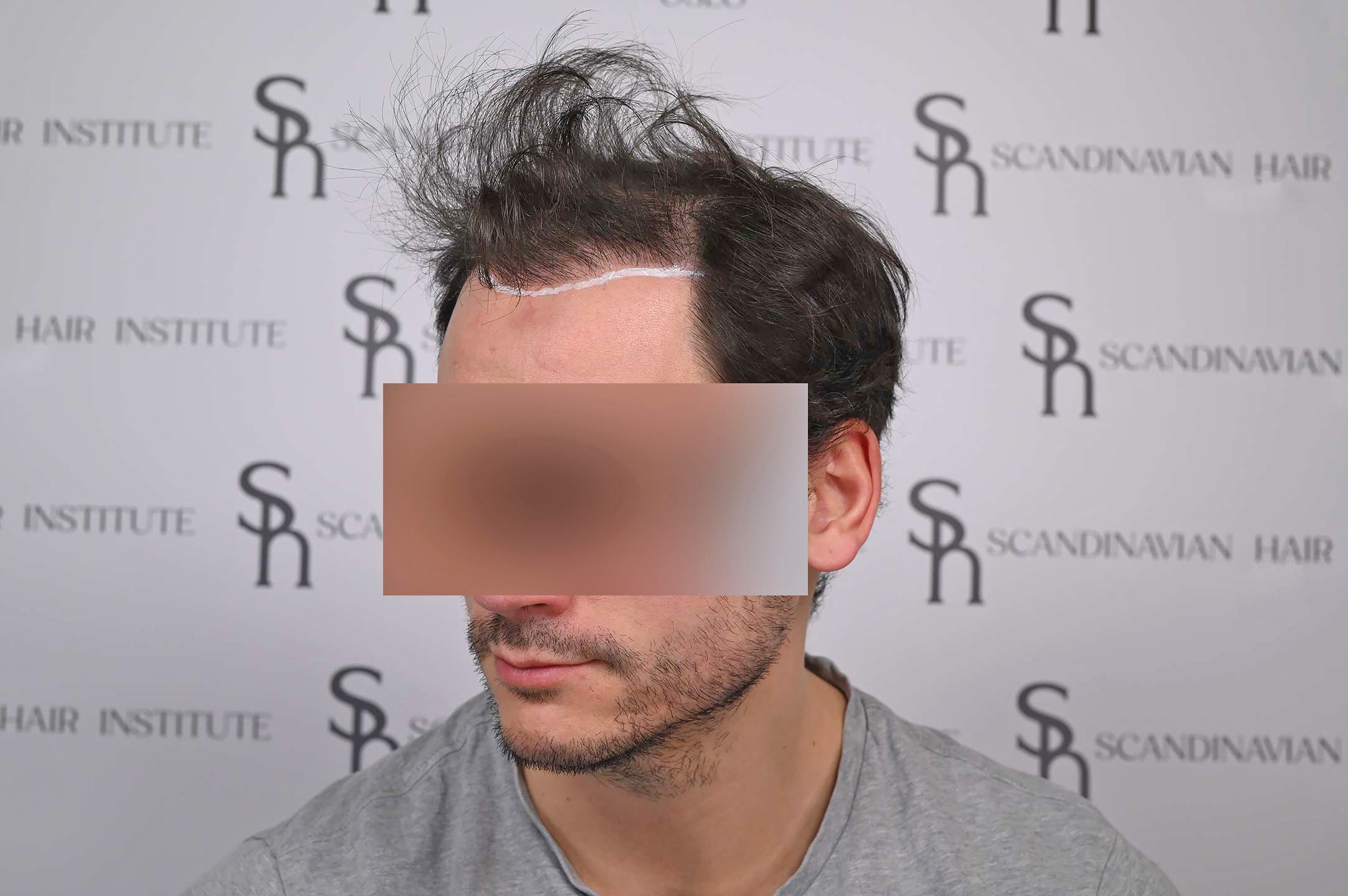 Repair of hairline - Scandinavian Hairinstitute