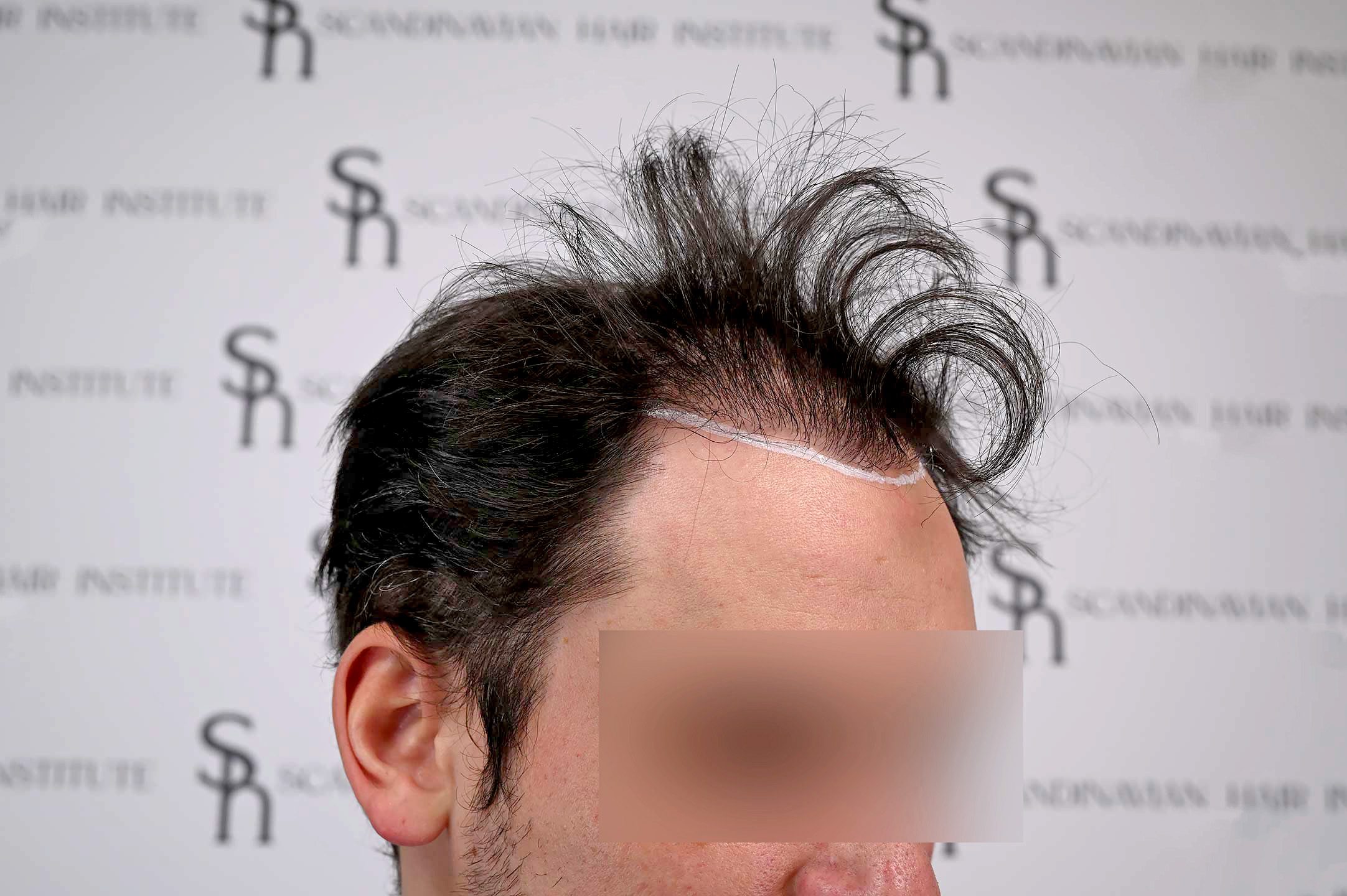 Repair of hairline - Scandinavian Hairinstitute