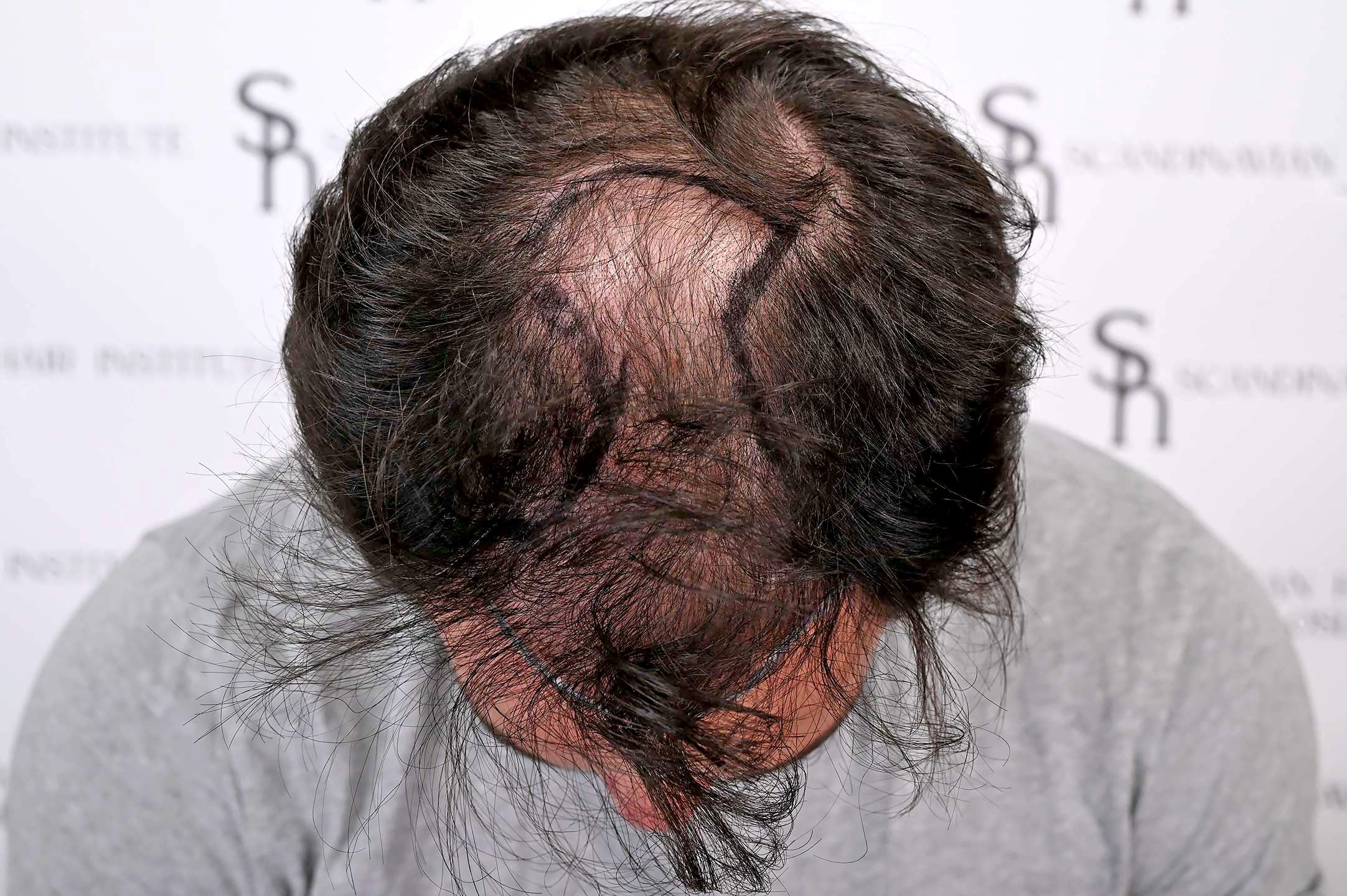 Repair of hairline - Scandinavian Hairinstitute